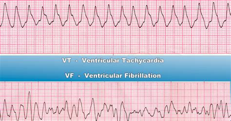 Tachycardia Manhattan Cardiology Manhattan Ny