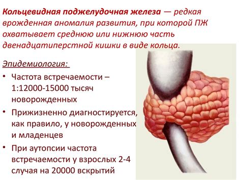 Поджелудочная железа Аномалии развития добавочная и кольцевидная поджелудочной железы