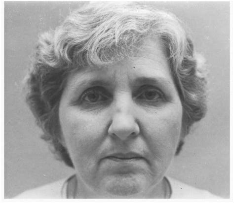 Parkinson Disease Neupsy Key