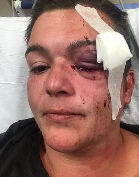 Sentí Que Mi Cara Explotaba” El Relato De Una Periodista Que Resultó Herida En Las Protestas