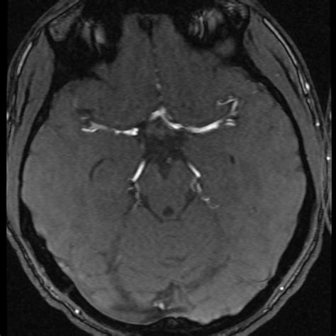 Azygos Anterior Cerebral Artery Radiopaedia 17059 16756 Axial Mra Nc Commons