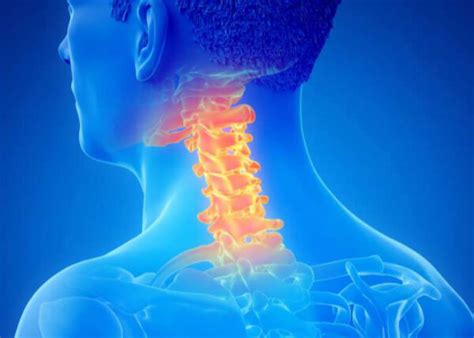 Cervical Posterior Decompression And Fusion Cpdf Neurosurgeon St Louis Creve Coeur