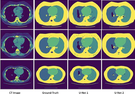 Improving Ct Image Segmentation Accuracy Using Stylegan Driven Data
