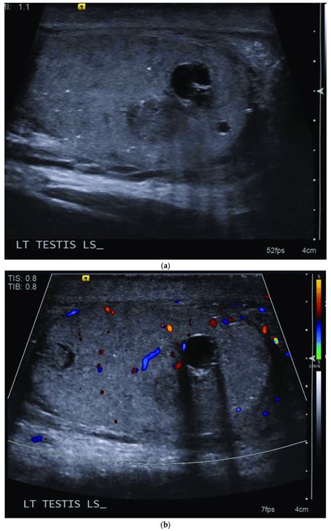 A B Mode Ultrasound Demonstrates Well Defined Intratesticular Cystic