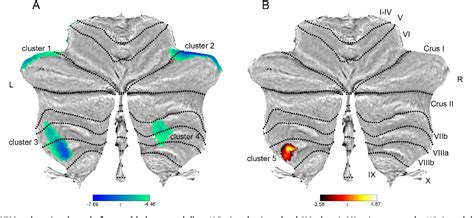 Cerebellar Gray Matter Alterations Predict Deep Brain Stimulation Outcomes In Meige Syndrome