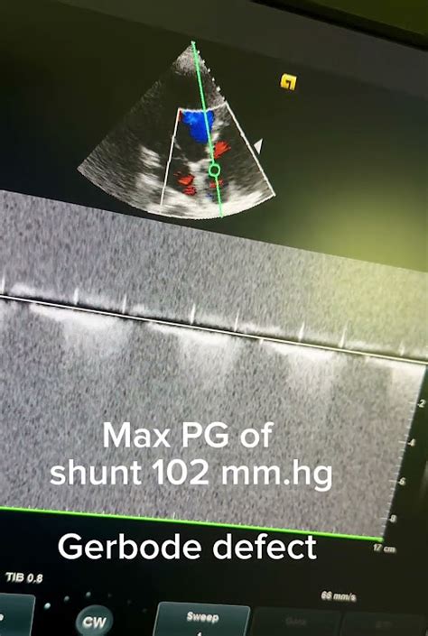 Gerbode Defectcredits To Doniyorov Shn Echocardiography Youtube