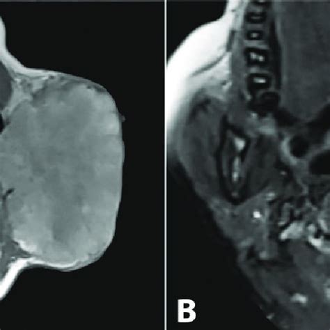 Head And Neck Mri A T1 Weighed Image Showing A Of Lobulated Parotid Download Scientific