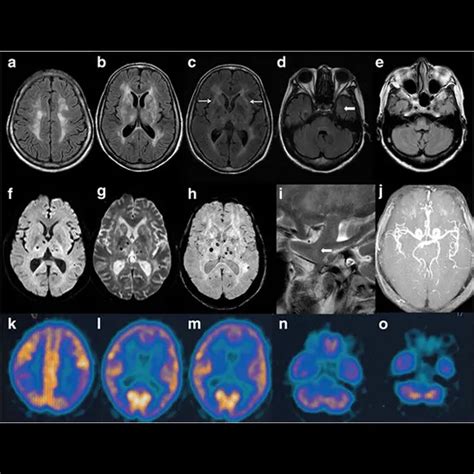 Fatal Familial Insomnia Test Price In Delhi Ganesh Diagnostic