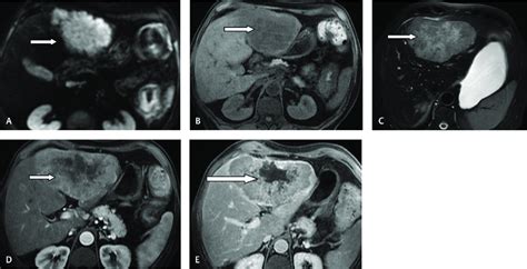 Mri Of The Liver A Axial Dwi Image Shows Restricted Diffusion