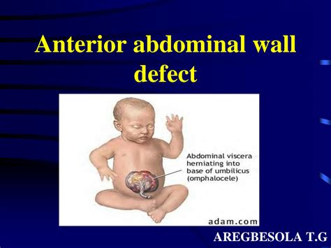 Solution Anterior Abdominal Wall Defect Studypool