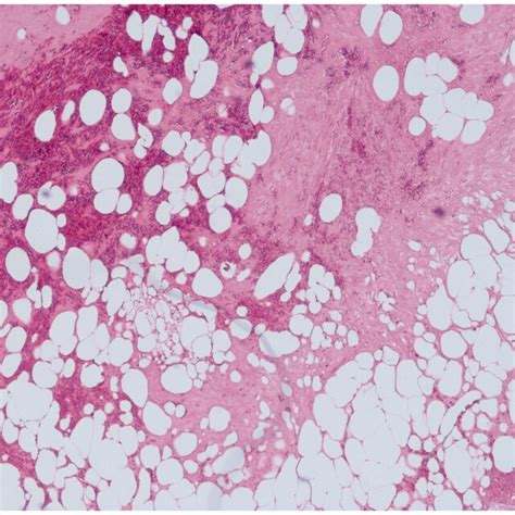 Gross Examination Reveal Pink Tan Tissue Fragments Download