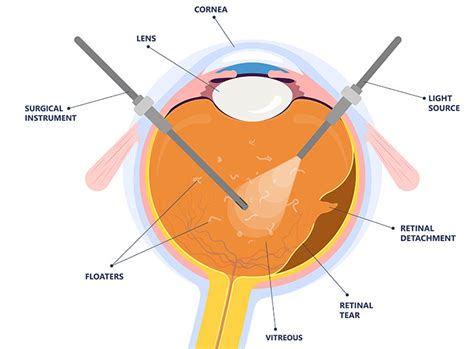 Vitrectomy Retinal Detachment