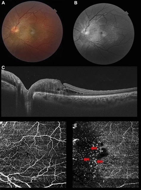 Filigree Vascular Pattern In Combined Hamartoma Of Retina And Retinal