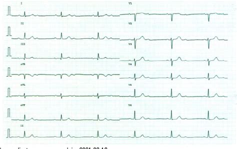 Figure 1 From A Case Report Of Complete Atrioventricular Block Treatment With Samulanshin Tang