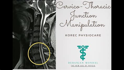 Cervico Thoracic Junction C7 T1 Manipulation Osteopathic And Chiropractic Manual Physical