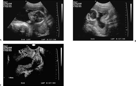 Dilated Cervix Ultrasound Smarty Pance Reproductive Content