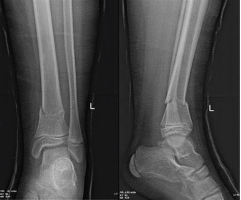 Distal Tibia Fracture Classification