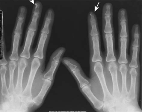 Progressive Systemic Sclerosis Flashcards Quizlet
