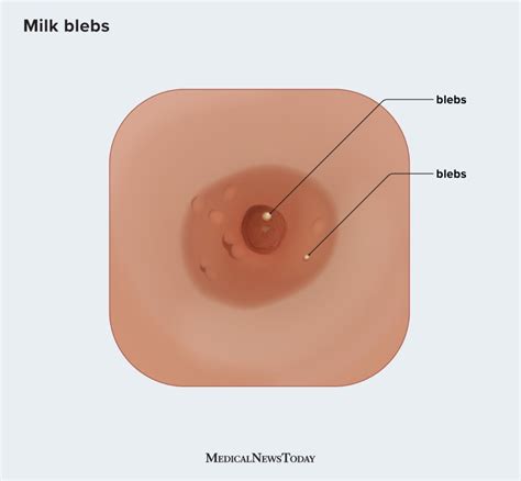 What Are Milk Blebs Symptoms Causes And More