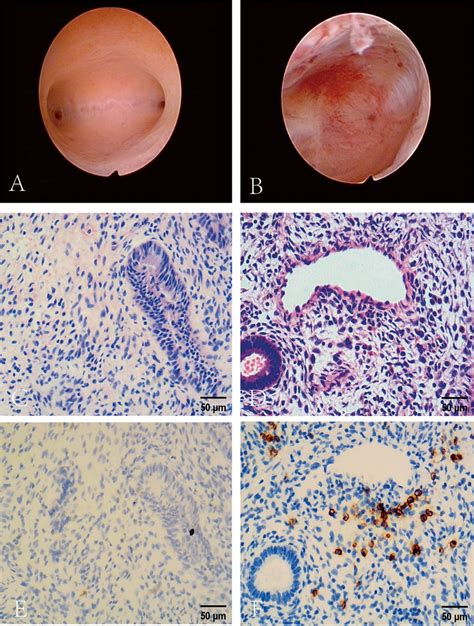 Hysteroscopy He Staining And Immunohistochemical Cd138 Staining Were