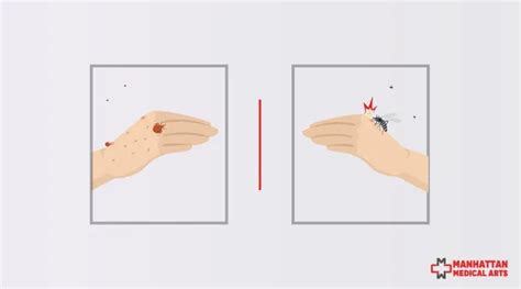 Mosquito Bites Vs Flea Bites What Do Bed Bugs Look Like 5 Signs To