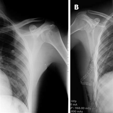 Posteroanterior Chest X Rays After Surgery A Posteroanterior Chest