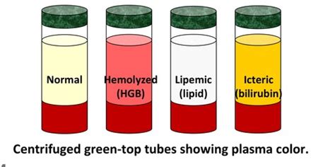 Icteric Specimen Icteric Specimen