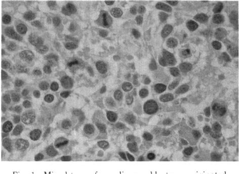 Figure 1 From Amplification Of N Myc Gene And Increase Of Urinary Vma And Hva In Patients With