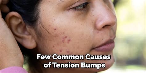 How To Get Rid Of Tension Bumps 10 Easy Steps 2025