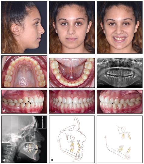 Hybrid Tad Supported Rpe For Skeletal Class Iii