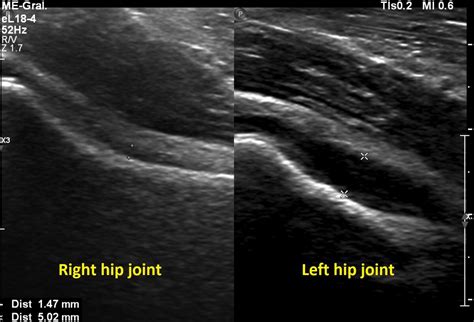 Radiopaedia Case Hip Joint Septic Arthritis Ultrasound Id 86091