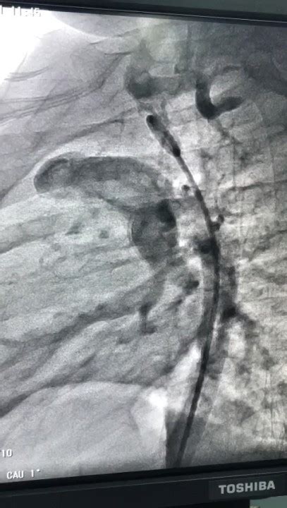 Video Professor Kamar T Adeleke On Linkedin An Amazing Pda Device Closure Done In An 18