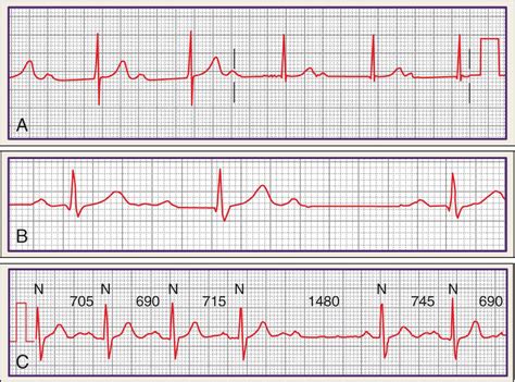 Conduction Disturbances And Cardiac Pacemakers Clinical Tree