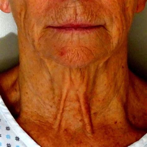Does Botox Help Neck Bands Facial Injections Info Prices Photos