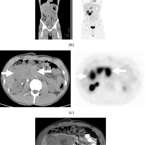 Lymph Node Size At Various Anatomic Sites Short Axis Diameter Upper