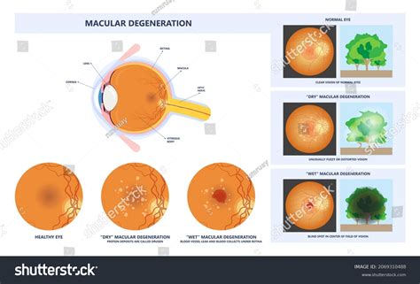 Macular Degeneration Diagram