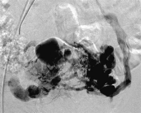 Diagnosis And Treatment Of Uterine And Pelvic Arteriovenous Malformations Endovascular Today