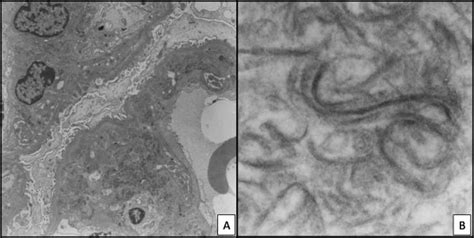 Case 1 2001 Electronic Micrographs Sections Show Expansion Of The