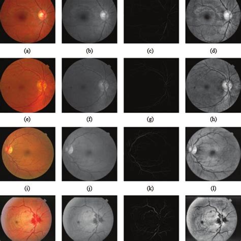 Pre Processing Of An Image From Messidor Stare Drive And Sant Joan