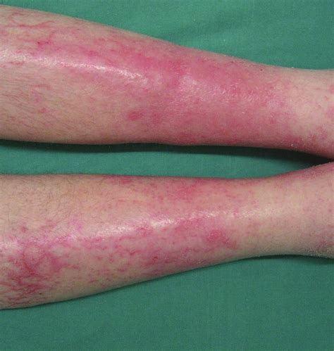 Crest Guidelines On The Management Of Cellulitis In Adults June 2005