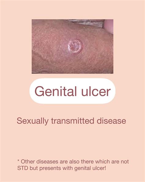 Nancy Lalnunpuii Private Area Ah Hian Ulcer Sex Atanga In Kai Chhawn