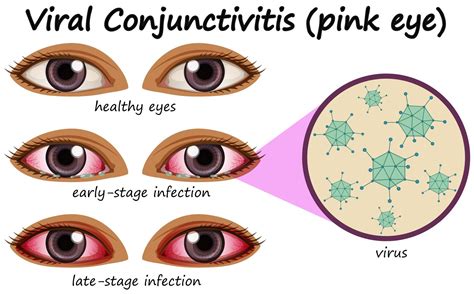 Human Eye Disease With Viral Conjunctivitis 455486 Vector Art At Vecteezy