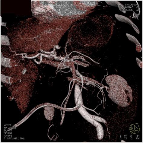 Perforated Gastric Ulcer With Bleed Stomach Radiology Case Studies