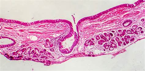 Fotomicrografía De Metaplasia Escamosa Epitelial Bronquial Foto De