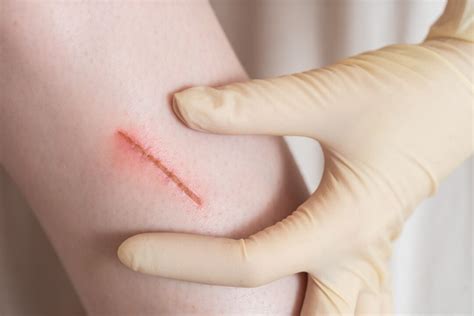 When Does A Wound Need Stitches Health Channel