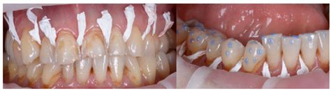 Selective Etching Of Surfaces And Application Of Adhesive System For