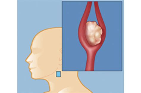 Paragangliomas Tumors