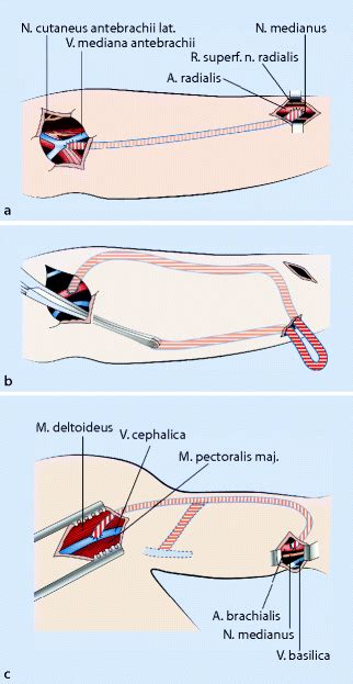Arteriovenöse Interponate Springerlink