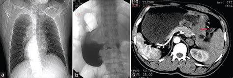 Three Dimensional Laparoscopic Treatment Of Situs Inversus T Journal Of Minimal Access Surgery