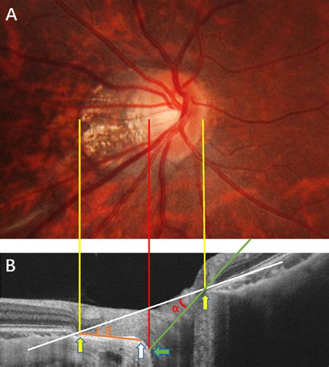 Onh Parameter Measurement In A Horizontal B Scan The Nasal And Download Scientific Diagram